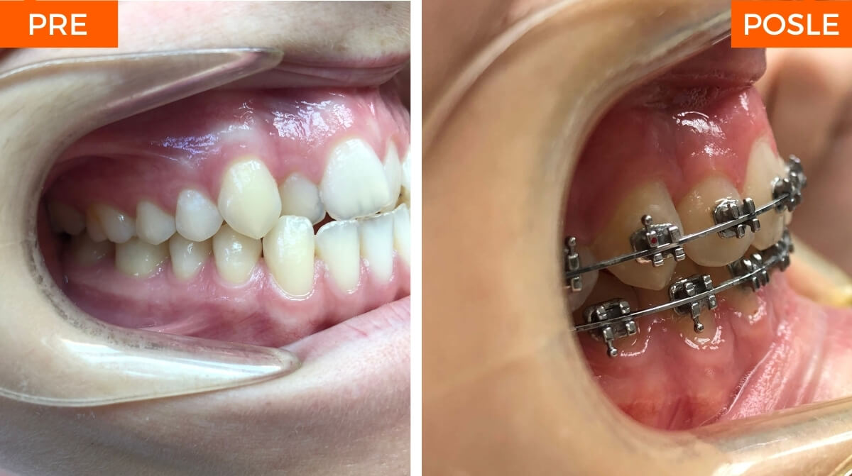Fiksne proteze | Lep i zdrav osmeh uz Šumice Dental Studio